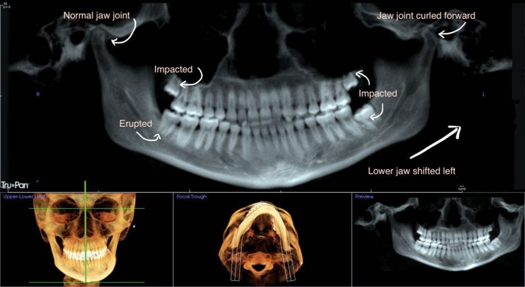 Wisdom Tooth Removal Kawana, Sunshine Coast | Lake View Dental