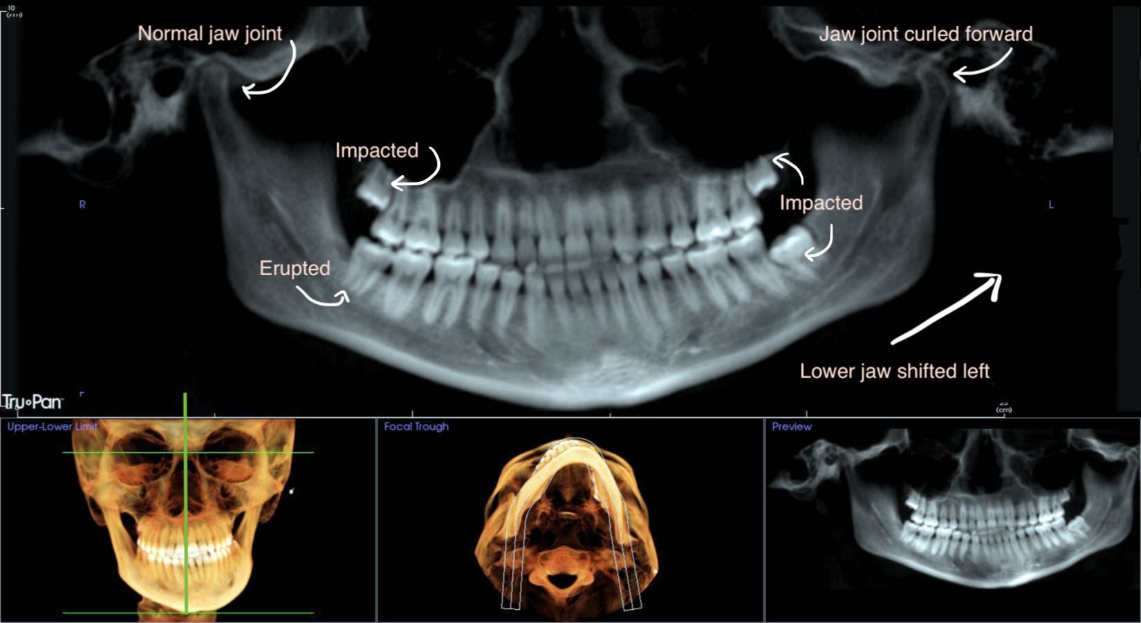 Wisdom Tooth Removal Kawana, Sunshine Coast | Lake View Dental